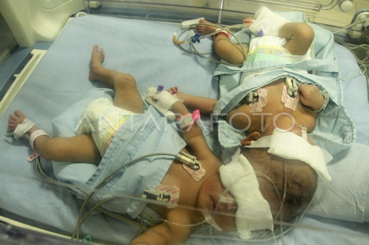 KELAHIRAN BAYI KEMBAR SIAM | ANTARA Foto