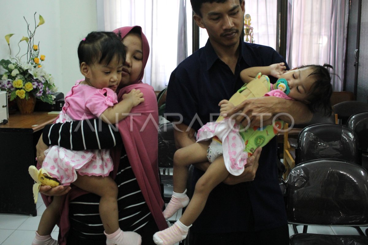 KEADAAN BAYI KEMBAR SIAM ASAL KENDARI | ANTARA Foto