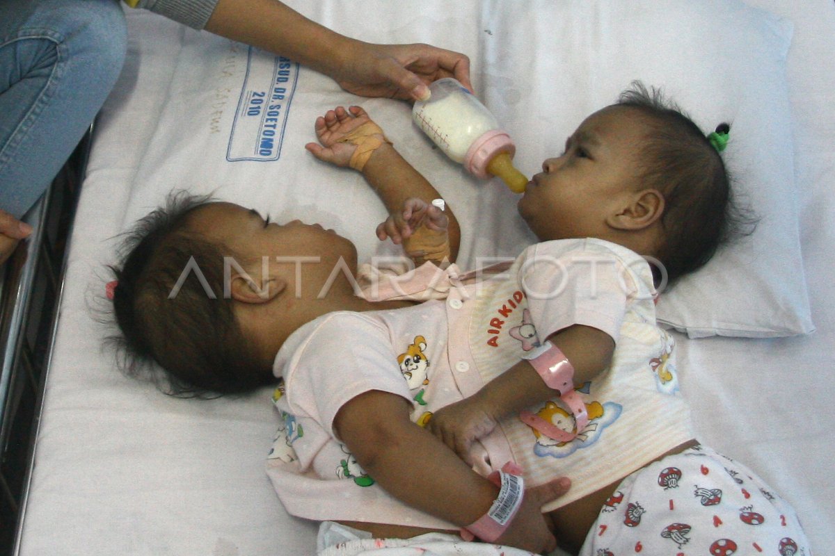 BAYI KEMBAR SIAM | ANTARA Foto
