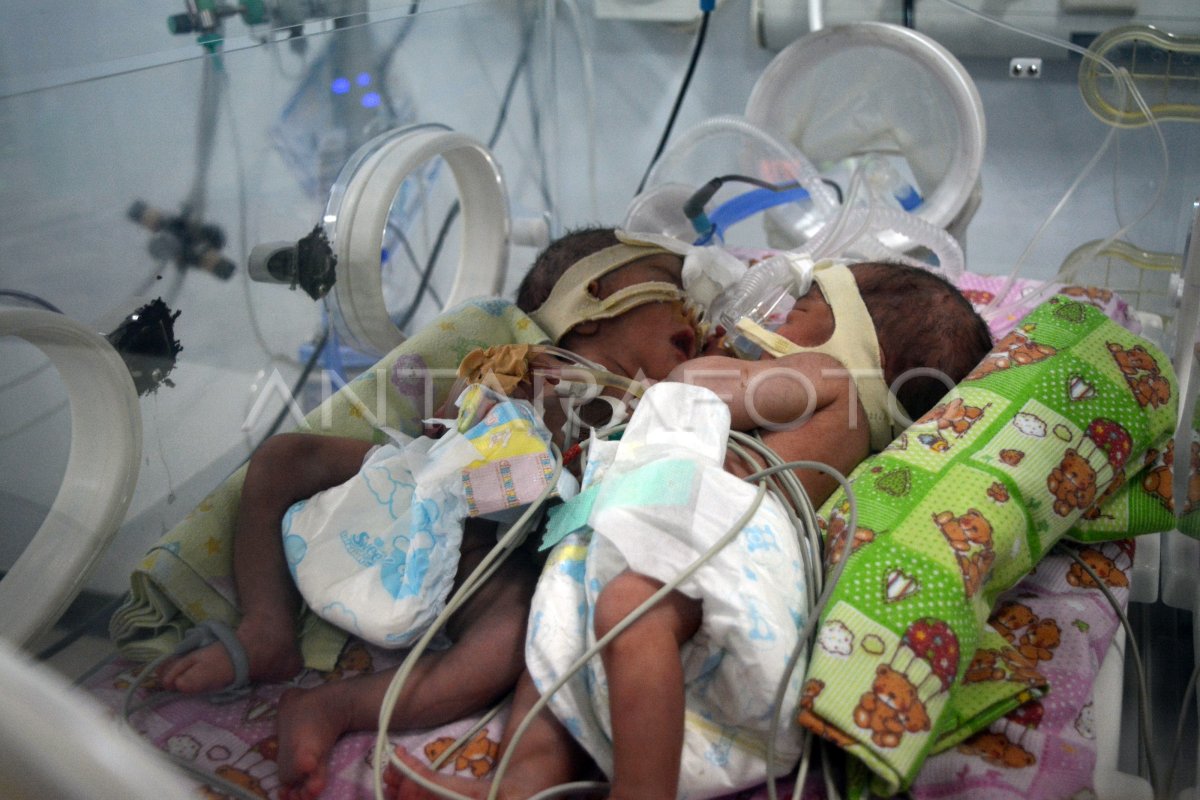 BAYI KEMBAR SIAM | ANTARA Foto