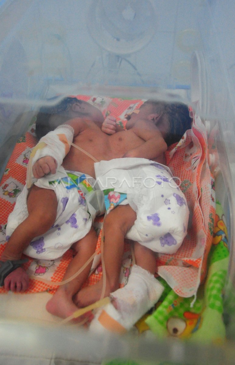 BAYI KEMBAR SIAM | ANTARA Foto